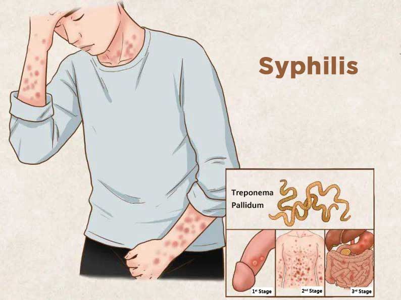 Syphilis gyorsteszt Alere Determine (100db/csomag) | Sunmed Kft ...